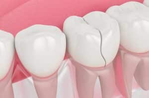 What Happens If You Ignore a Cracked Tooth? - Apex Endodontic Studio